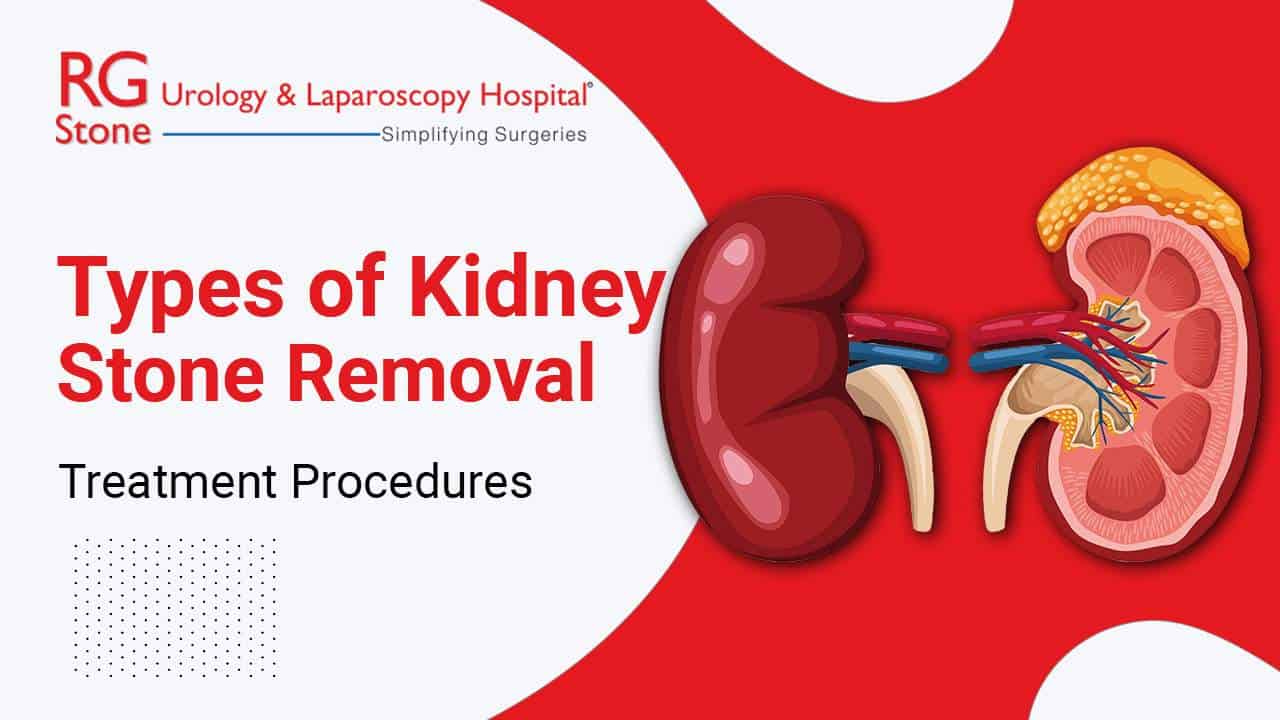 Best Urology & Kidney Hospital in Ludhiana, Punjab | RG Stone Urology ...